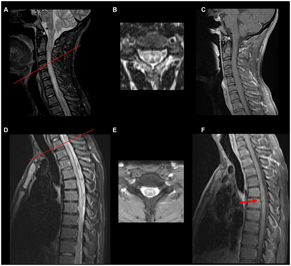 Frontiers | Transverse myelitis in myelin oligodendrocyte glycoprotein ...