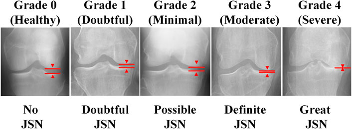 Frontiers | Classification of knee osteoarthritis based on quantum-to ...