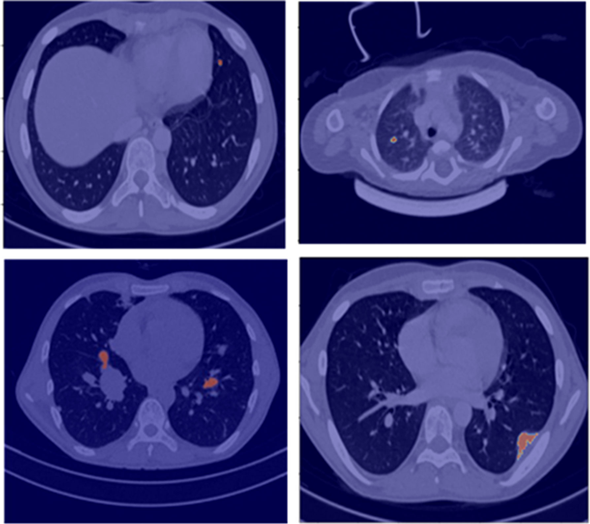 Frontiers | A proposed methodology for detecting the malignant potential of pulmonary nodules in ...