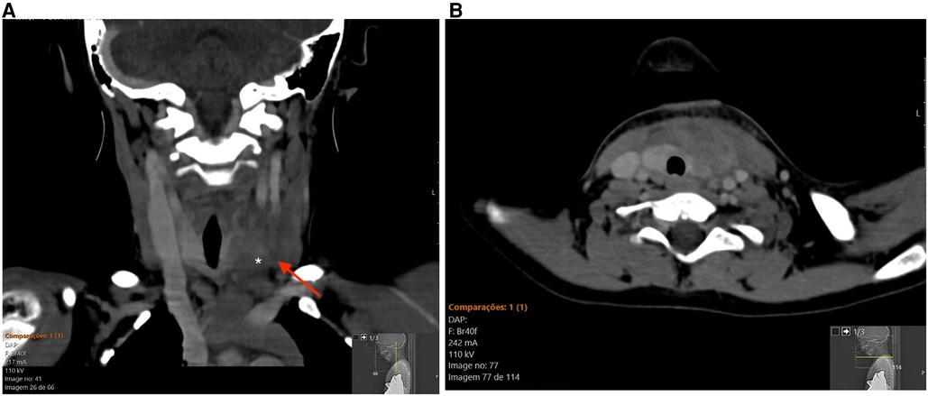 Frontiers | Case report: Fourth branchial cleft cyst: a case of acute ...