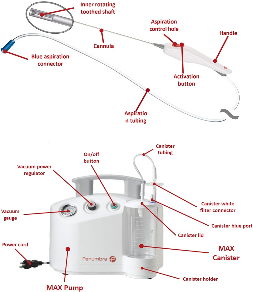 Frontiers | Use of a neuro-evacuation device for the endoscopic removal ...