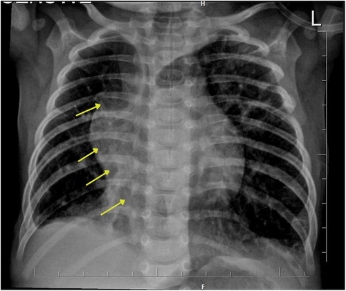 Frontiers | Case report: A unique quadruple coexisting anomaly—scimitar ...