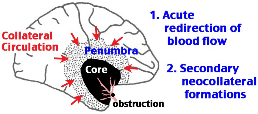 Frontiers | Impaired post-stroke collateral circulation in sickle cell anemia mice