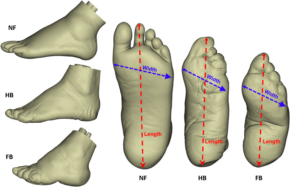 Frontiers | Understanding the form and function in Chinese bound foot ...