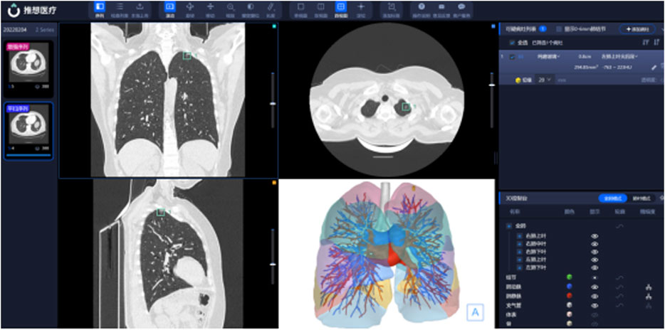 Frontiers | A new method for evaluating lung volume: AI-3D reconstruction
