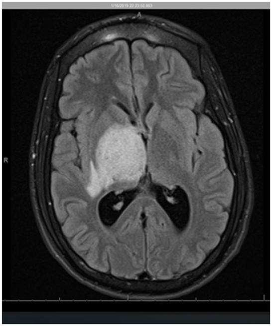 Frontiers | Case report: A case of neuro-Behçet's syndrome presenting ...