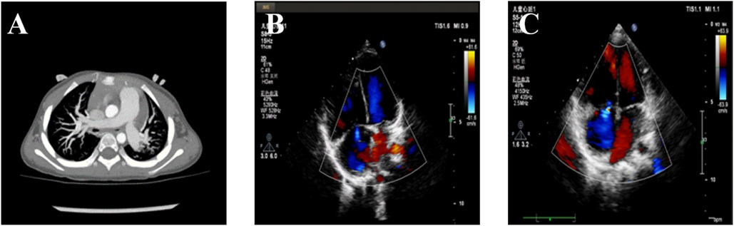 Frontiers | Case Report: Identification of microduplication in the ...