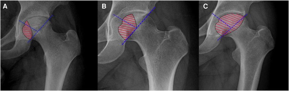 Frontiers | Core decompression vs. allogenic non-vascularized bone ...