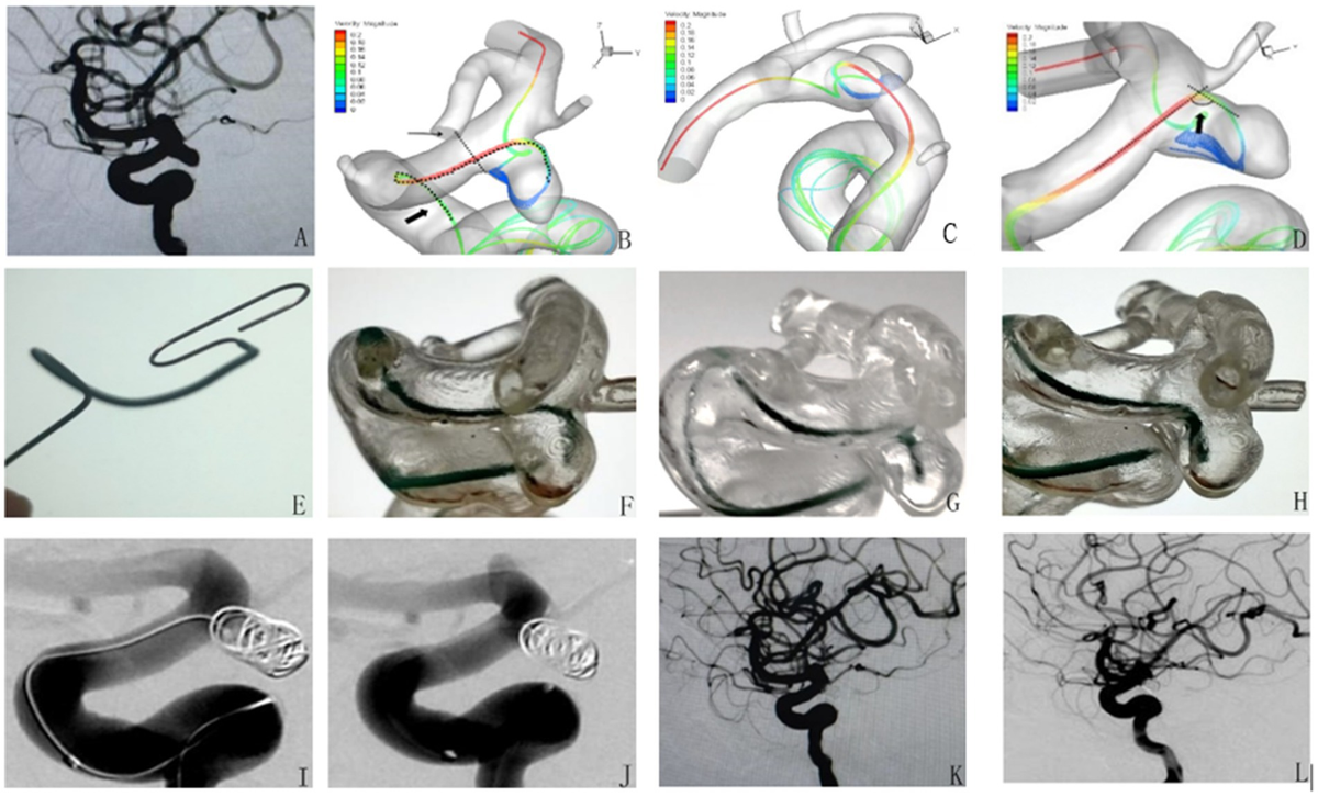 Frontiers | Application of microcatheter shaping based on computational ...