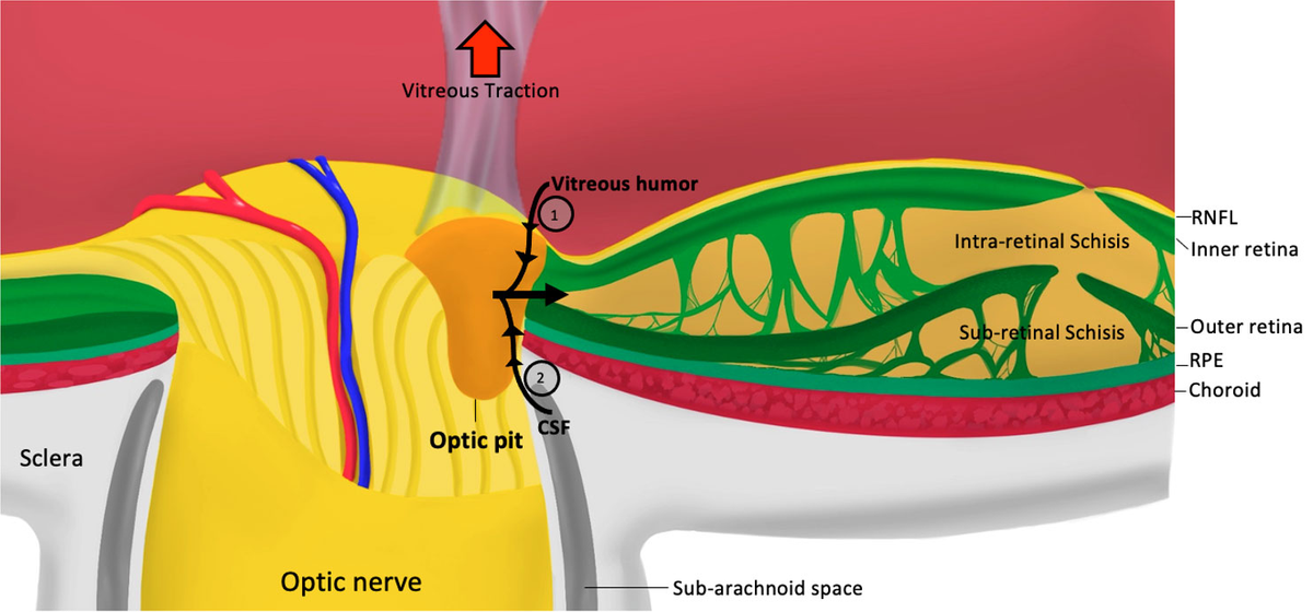 Frontiers | Congenital optic disc pits and optic disc pit maculopathy ...