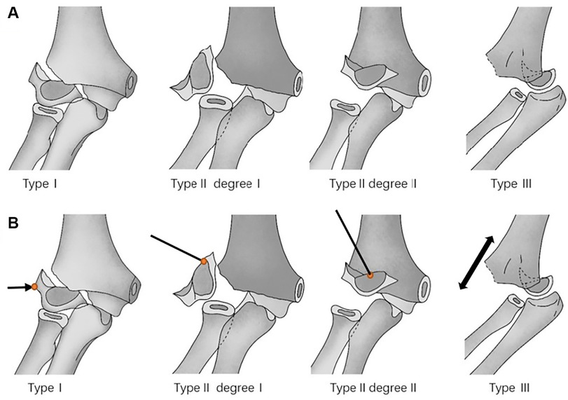Types Condylar Distal Humerus Fractures