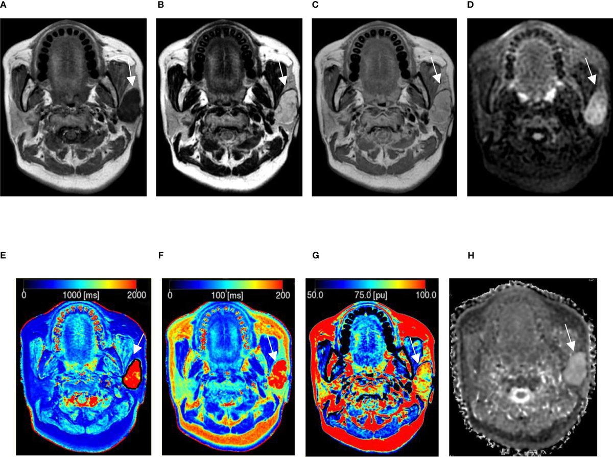 Frontiers | Synthetic MRI plus FSE-PROPELLER DWI for differentiating ...