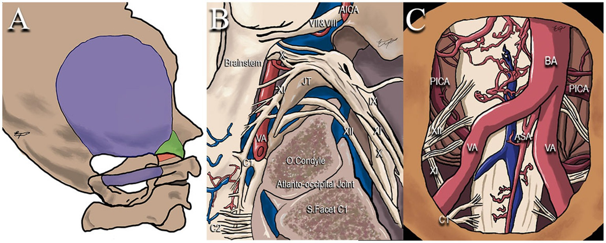 Frontiers | Surgical corridors to foramen magnum meningiomas: a mini-review