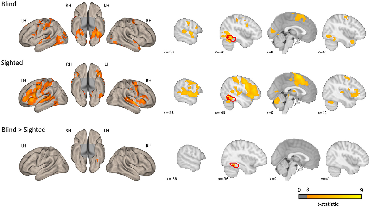 Frontiers | The role of the left ventral occipitotemporal cortex in speech processing—The ...
