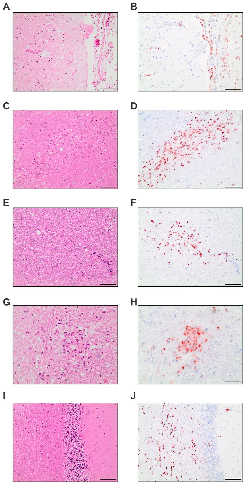 Frontiers | Neuropathology in COVID-19 autopsies is defined by ...
