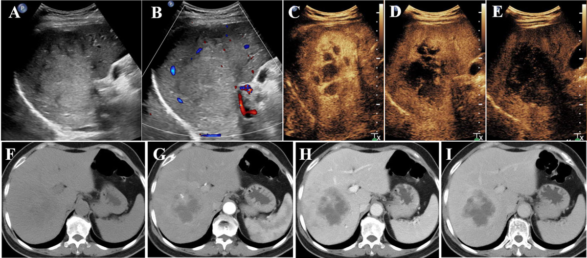 Frontiers | Primary hepatic squamous cell carcinoma: case report and ...
