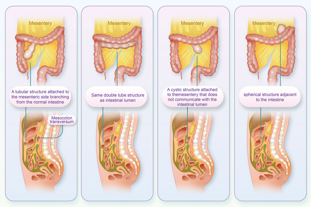 Frontiers | Duplication of the transverse colon in adults: a case ...