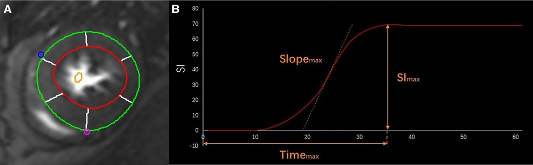 Frontiers | Improvement in coronary microvascular dysfunction evaluated ...