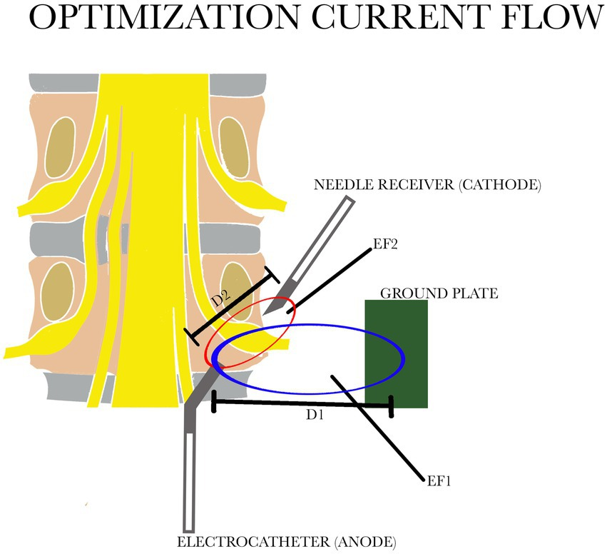 Frontiers | The treatment of persistent spinal pain syndrome with ...