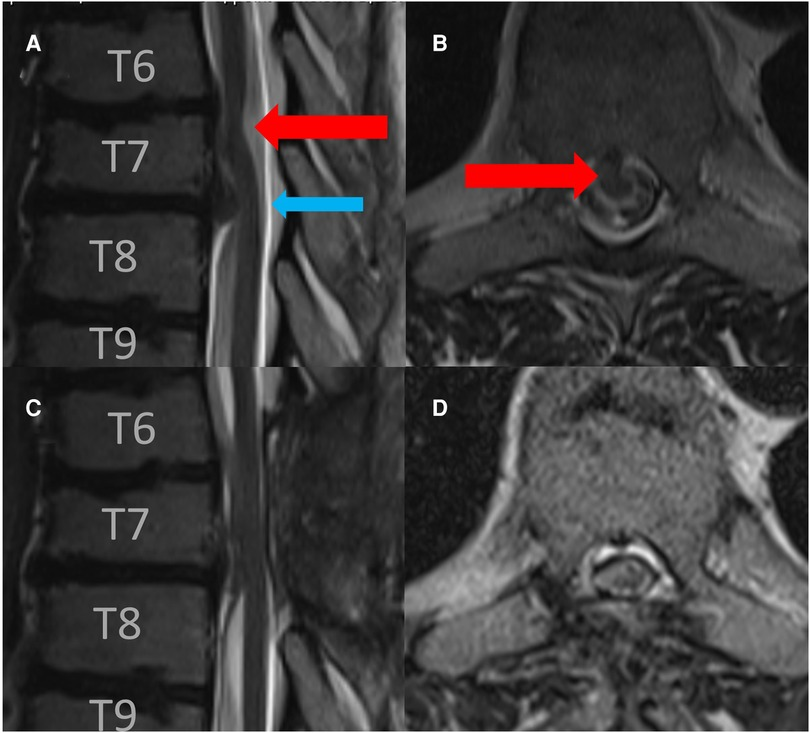 Frontiers | Case report: A vertebral bone spur as an etiology for ...