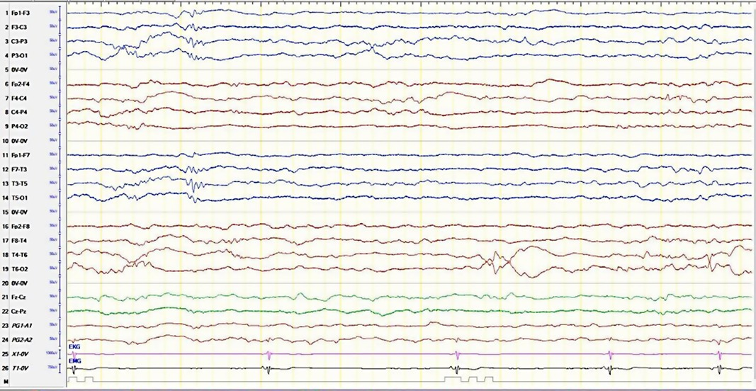 Frontiers | Anti-U1RNP-70kD-positive case of neonatal lupus presenting ...