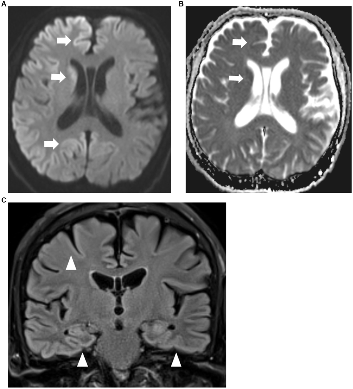 Frontiers | Case report: Creutzfeldt-Jakob disease presenting with ...
