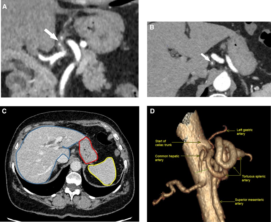 Frontiers | Case report: Isolated dissection of the left gastric artery ...