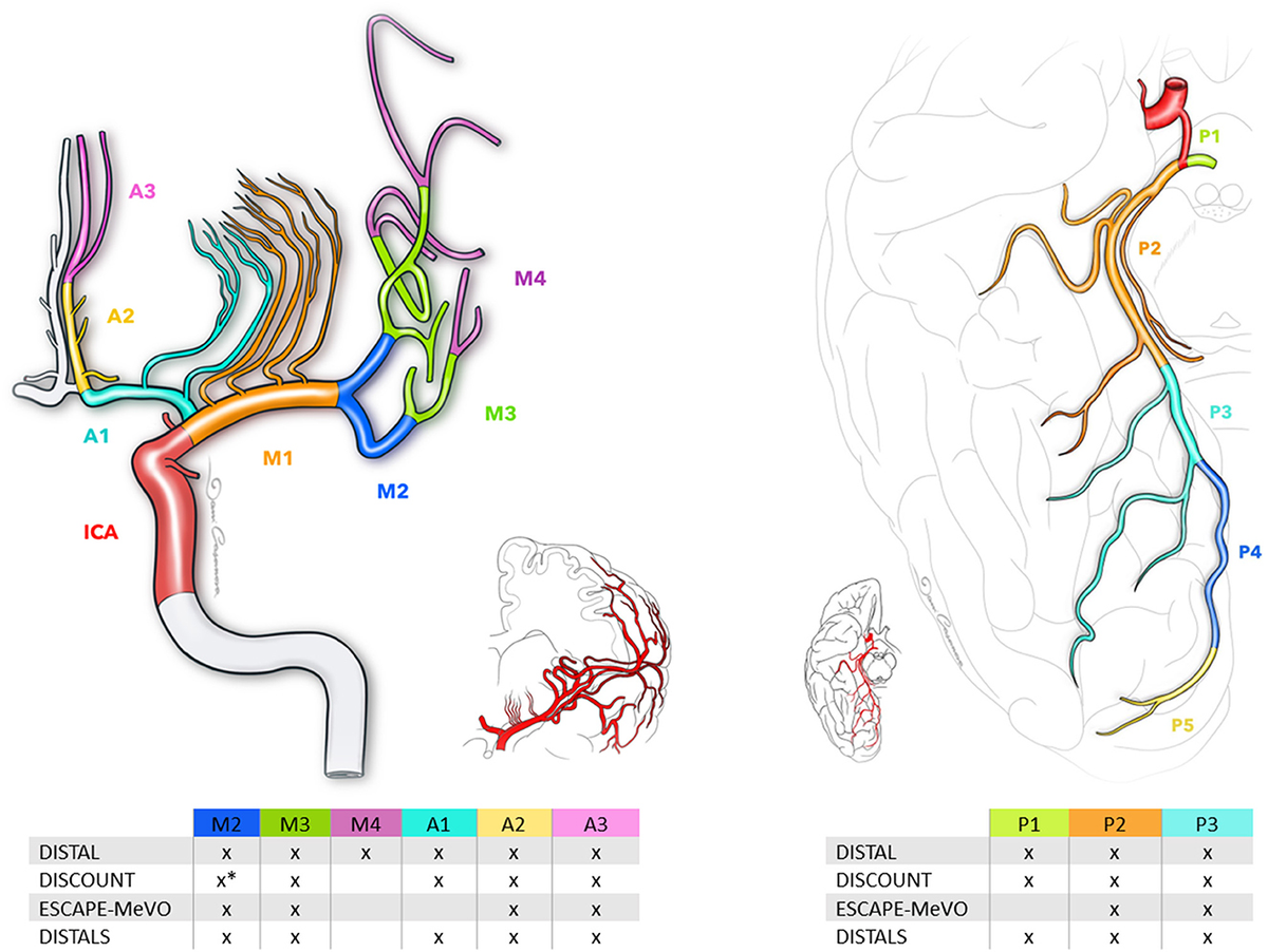 Frontiers | Current challenges in the endovascular treatment of medium vessel occlusions