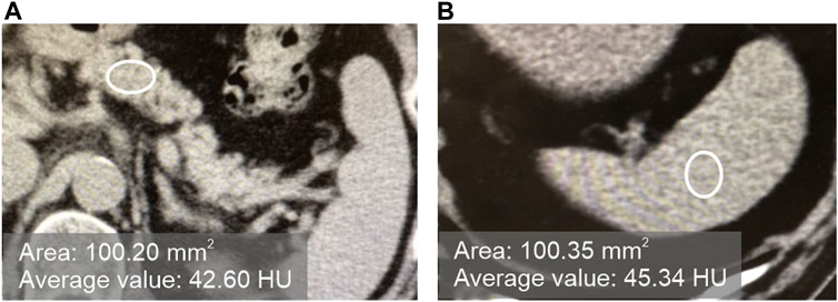 Frontiers | Risk factors for fatty pancreas and effects of fatty ...