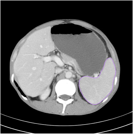 Frontiers | A novel role of the splenic volume in Crohn’s disease ...