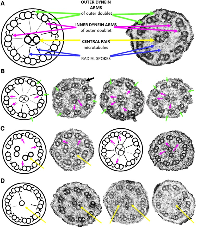 Frontiers | Ultrastructure for the diagnosis of primary ciliary ...