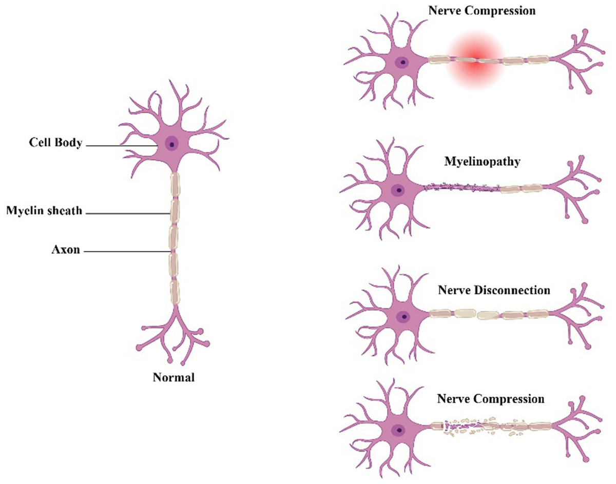 Frontiers | Imaging diagnosis in peripheral nerve injury