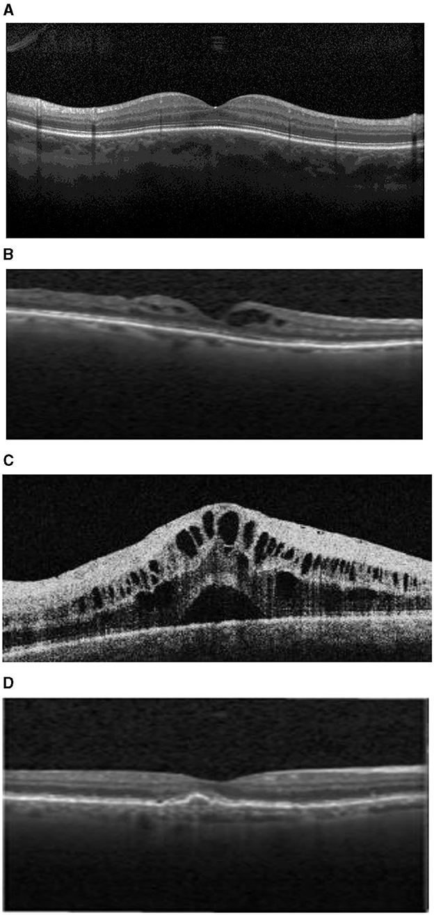 Frontiers | Deep learning-based classification of eye diseases using Convolutional Neural ...