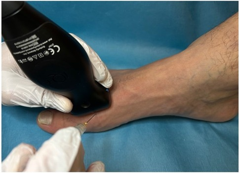 Frontiers | Case Report: Portable handheld ultrasound facilitates intra ...