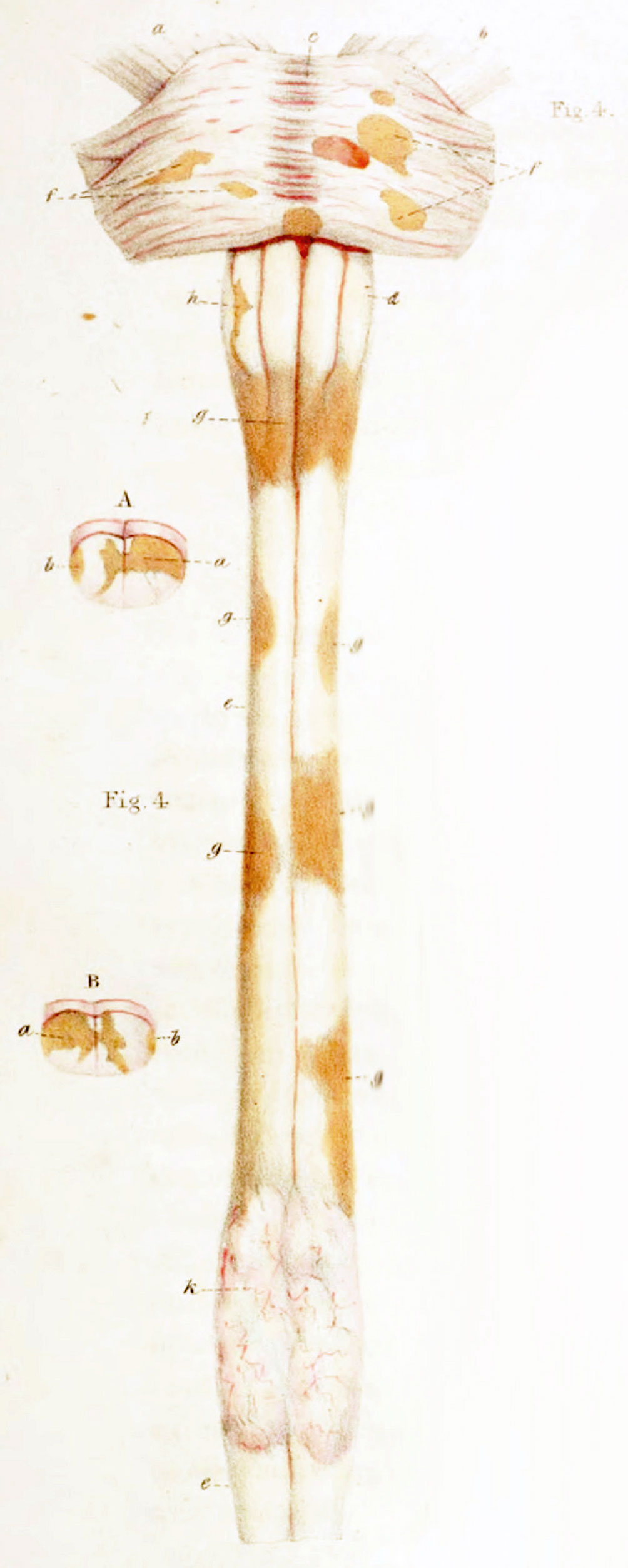 Frontiers | Astrogliosis in multiple sclerosis and neuro-inflammation ...