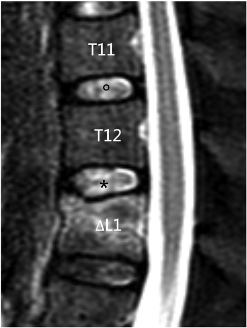 Frontiers | Effect of bone cement distribution on adjacent disc ...