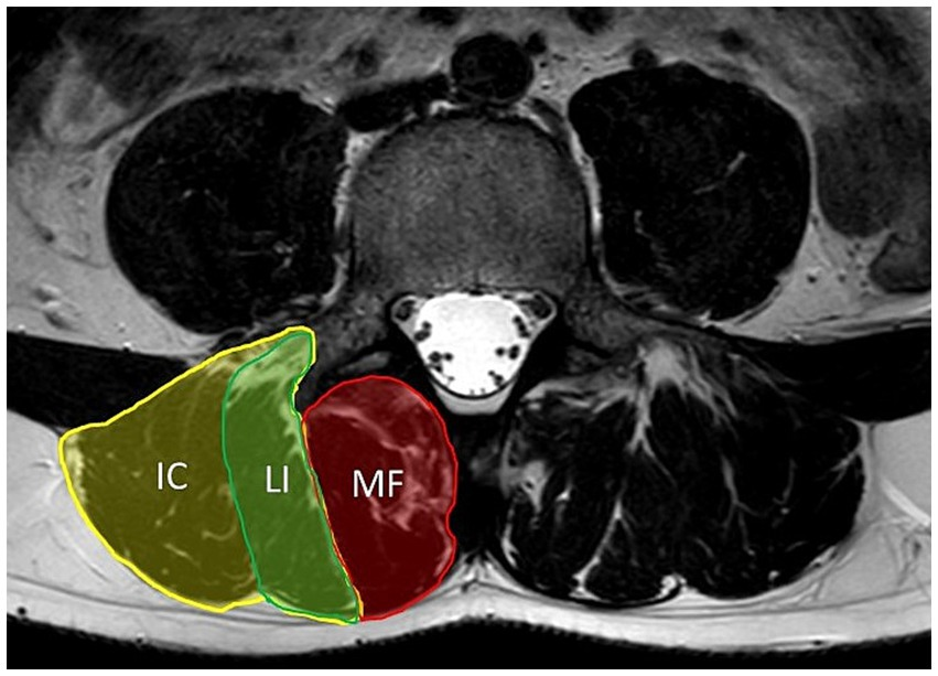 Frontiers | Trunk muscle dysfunction in patients with myotonic ...