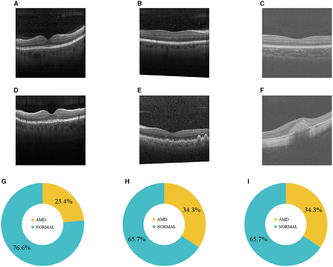 Frontiers | Federated learning for diagnosis of age-related macular degeneration