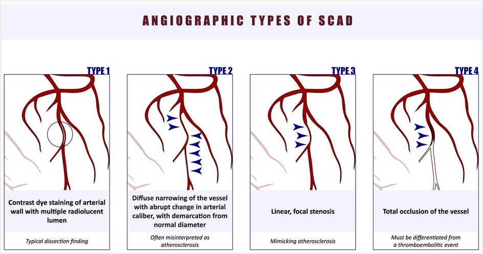 Frontiers | Pathophysiology of spontaneous coronary artery dissection ...