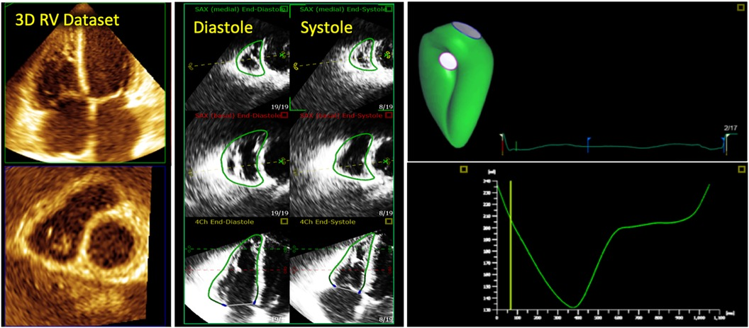 Frontiers | Added value of 3D echocardiography in the diagnosis and prognostication of patients ...