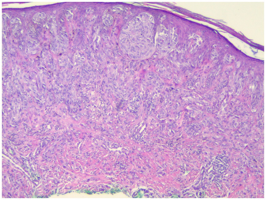 Frontiers | PRAME immunohistochemistry compared to traditional FISH ...