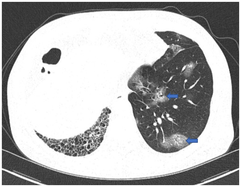 Frontiers | Pulmonary nocardiosis following COVID-19 in a patient with ...