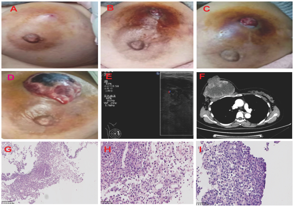 Frontiers | Case report: The first case of concurrent breast myeloid ...