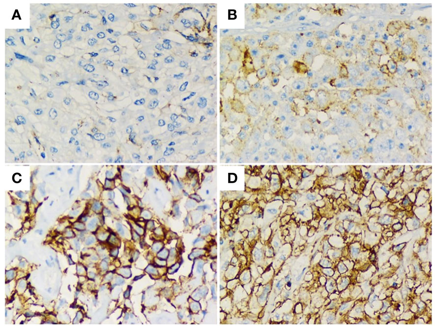 Frontiers Pd L1 Expression Complements Calgb Prognostic Scoring