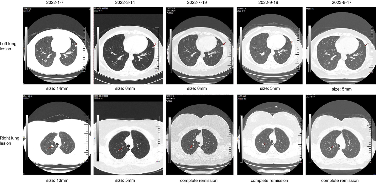 Frontiers | Case Report: Successful immune checkpoint inhibitor-based ...