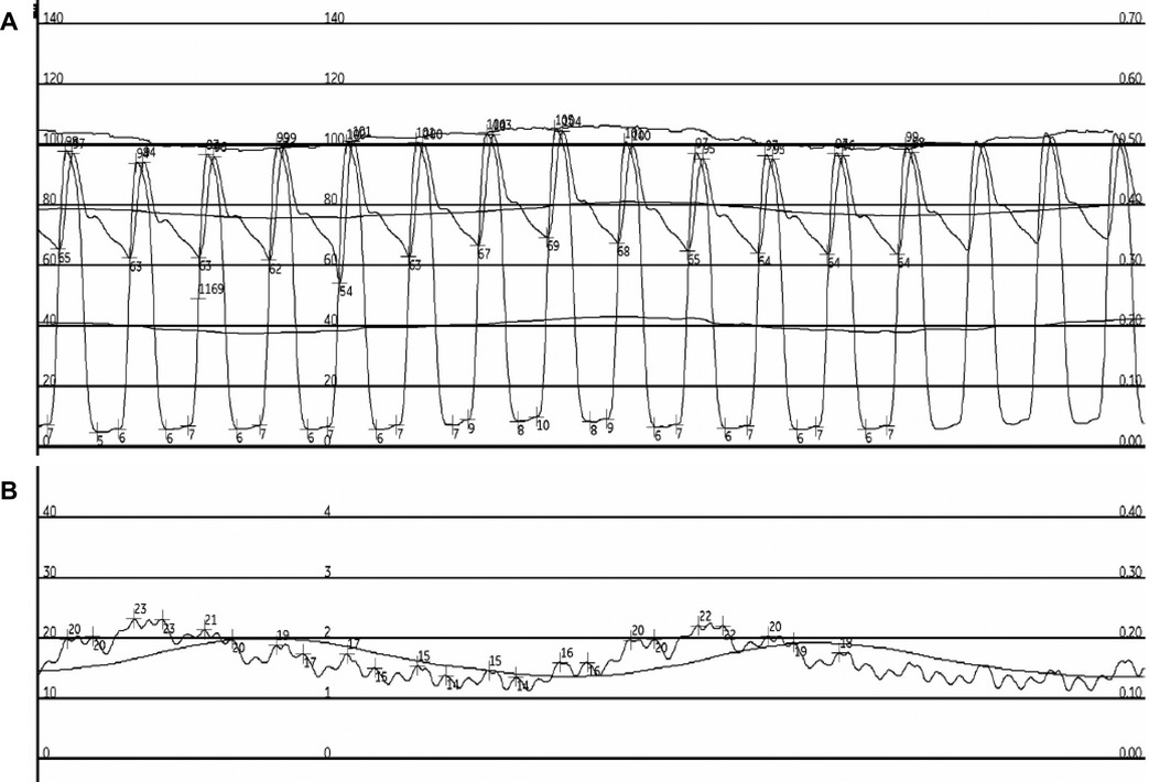 Frontiers | Case Report: Correlation between pulmonary capillary wedge ...