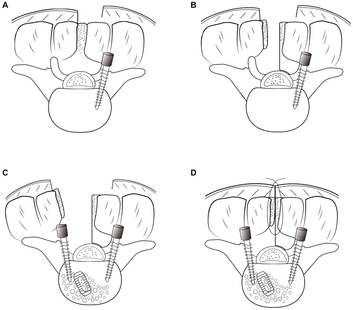 Frontiers | Unilateral transforaminal lumbar interbody fusion through a modified hemilateral ...