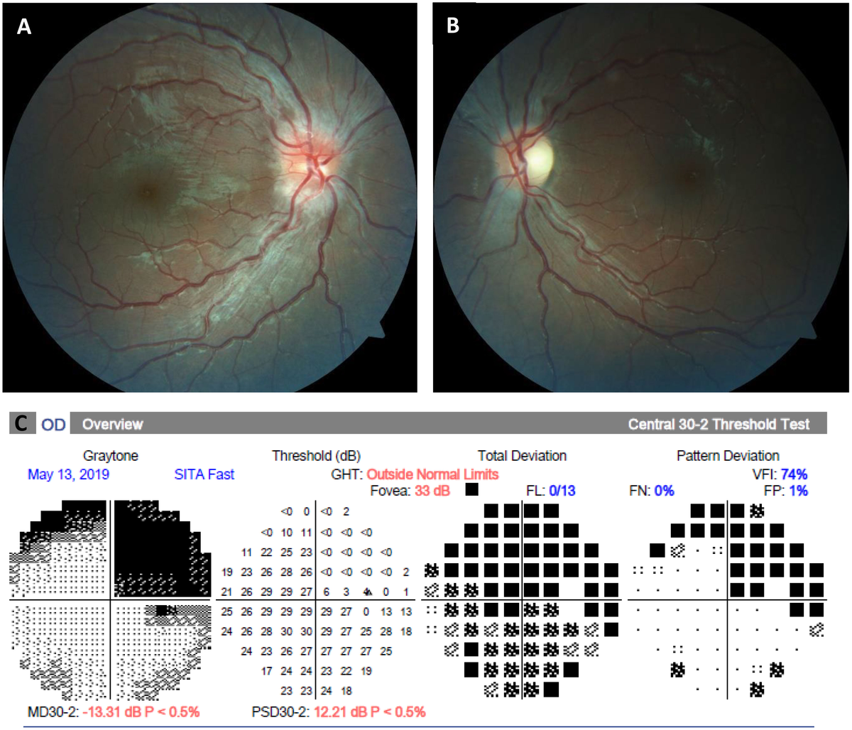 Frontiers | Pediatric autoimmune retinopathy and optic neuropathy: a ...