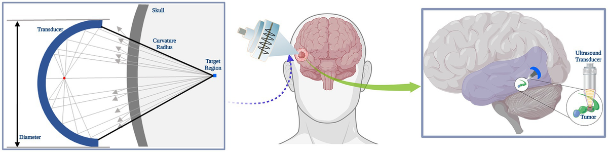 Frontiers | A transducer positioning method for transcranial focused ...