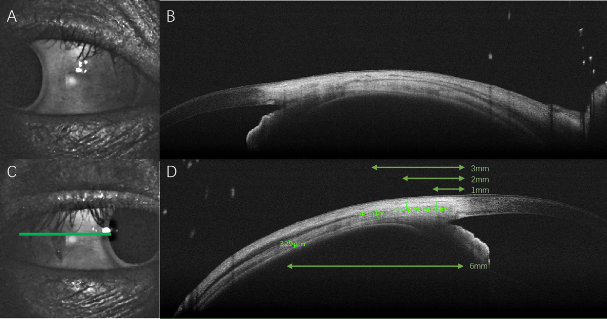 Frontiers | Scleral changes in systemic lupus erythematosus patients ...